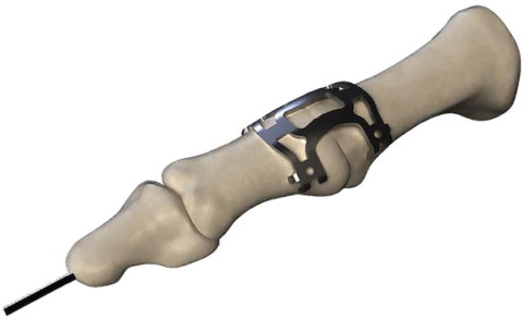 ExoToe | Hammertoe Fixation Made Easier